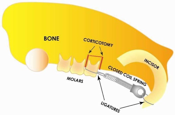 Corticotomy Hospital & Doctors in India - HBG Medical Assistance