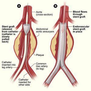 Stent (EVAR) for Descending of Aorta Hospital & Doctors in India - HBG ...