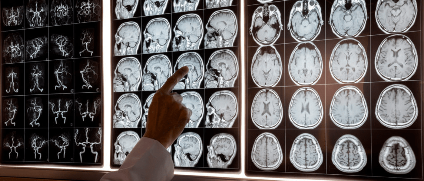 Endoscopic Brain Tumor Surgery at Brandon Premo blog